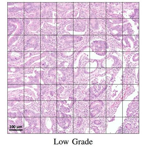 Pdf Context Aware Convolutional Neural Network For Grading Of