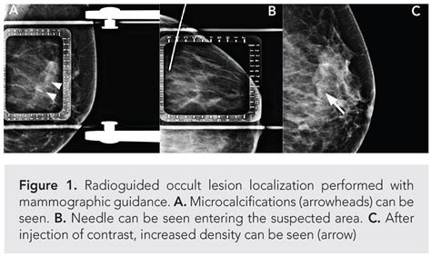 Radioguided Occult Lesion Localization Versus Wireguided Localization Of Nonpalpable Breast
