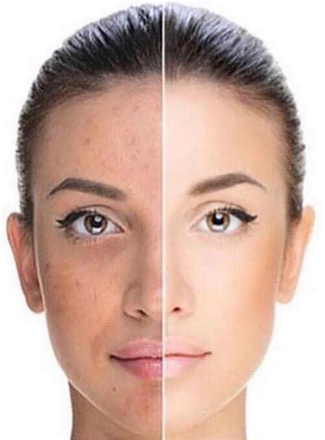 რა არის პილინგი და როდის უნდა მივმართოთ კოსმეტოლოგს პროცედურის დადებითი თვისებები და სახეები