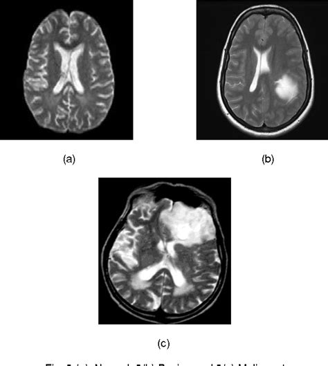 Figure 2 From Brain Tumor Classification Using Wavelet And Texture
