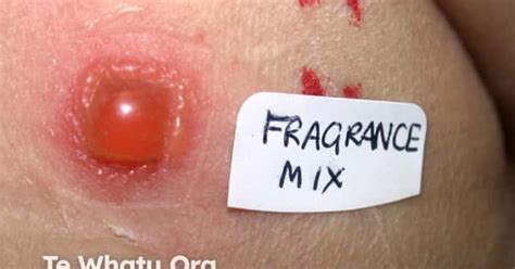 Strongly Positive Patch Test To Fragrance Image