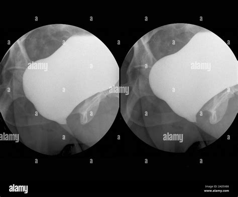 Urodynamic Bladder Test Retrograde Cystography Images Bladder X Ray