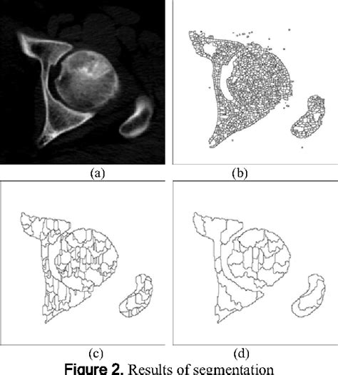 figure 2 from a medical image segmentation method based on watershed transform semantic scholar