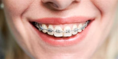 The Health Benefits Of Braces For Your Oral Health