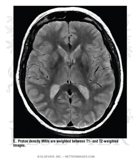 Proton Density Mris Are Weighted Between T1 And T2 Weighted Images