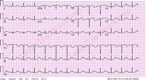 Prolonged Qt Interval Ecg Review Learn The Heart