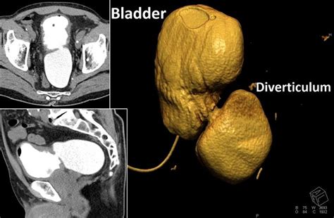 Bladder Diverticulum