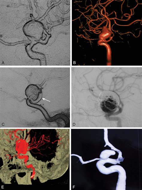 Surgical Treatment Of Paraclinoid Aneurysms Clinical Tree