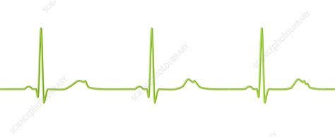 Long Qt Syndrome Type 2 Electrocardiogram Illustration Stock Image F042 7741 Science