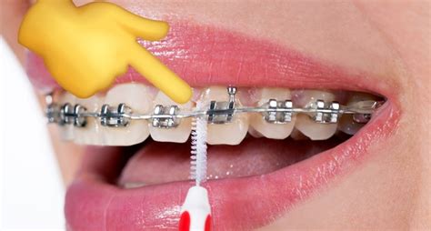 Cepillo Interproximal Para Ortodoncia ¿cómo Usarlo