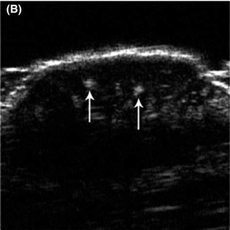 A Anechoic Areas Arrows A Nodular Bcc On Right Cheek Examined By Download Scientific