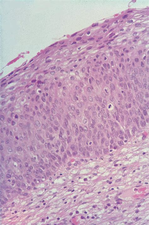 Cervical Neoplasms Clinical Tree