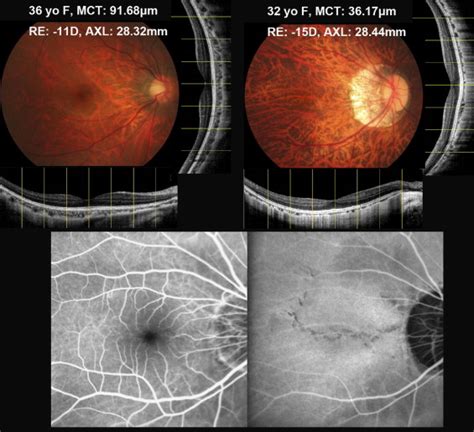 classification of early dry type myopic maculopathy with macular choroidal thickness ento key