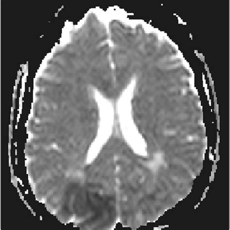 ADC Map After 5 Months Download Scientific Diagram