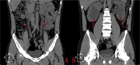 Computed Tomography Showing Bilateral Ureterectasis Arrow A And