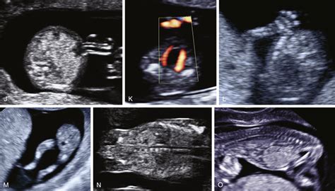 Ultrasound Screening For Fetal Abnormalities In The First Trimester Obgyn Key