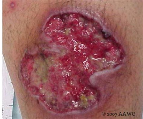 Pyoderma Gangrenosum Is A Necrotizing Skin Condition