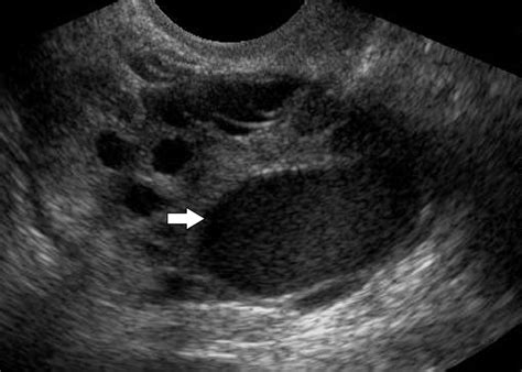 Endometrioma Ultrasound