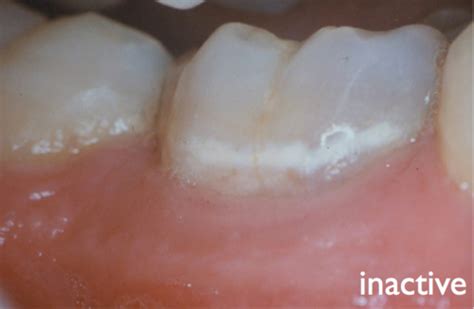 Dh70 Lecture 6 2 Caries Development Detection Classification Of Restorations Flashcards Quizlet