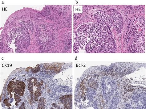 Microscopic Findings Of The Esophageal Tumor Biopsy A There Is Download Scientific Diagram