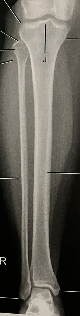 AP Right Tibia Fibula Anatomy Diagram Quizlet