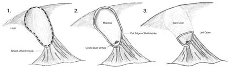 Subtotal Cholecystectomy The Operative Review Of Surgery