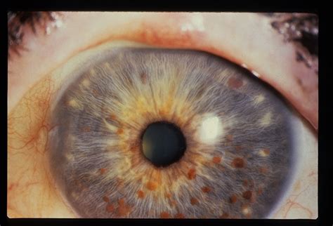 Iris Nodules