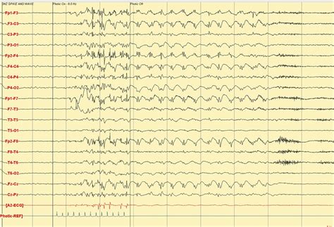 Myoclonus As A Manifestation Of Reflex Seizures Journal Of Clinical Neurophysiology