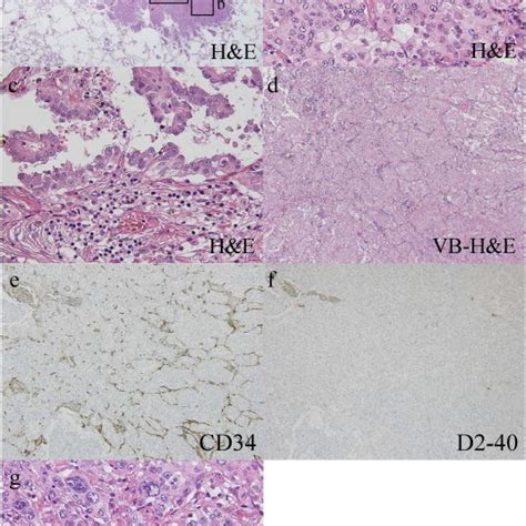 Preoperative Computed Tomography Ct Findings A 7×5 Mm Subpleural Download Scientific Diagram