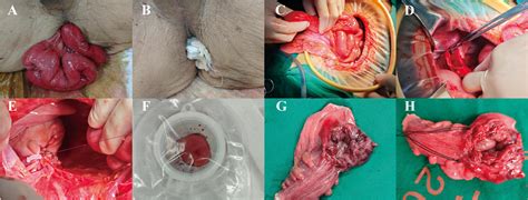 Frontiers Sudden Rupture Of Recurrent Rectal Prolapse Complicated By Small Intestine