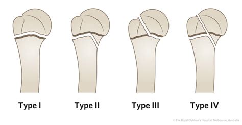 Humerus Fracture