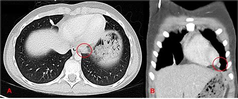 Ewing Sarcoma Jaw