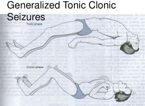 Seizure Disorder Ivyleaguenurse Unlimited Nurse Ceus