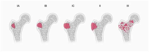 Lodwick Klassifikation Doccheck Flexikon