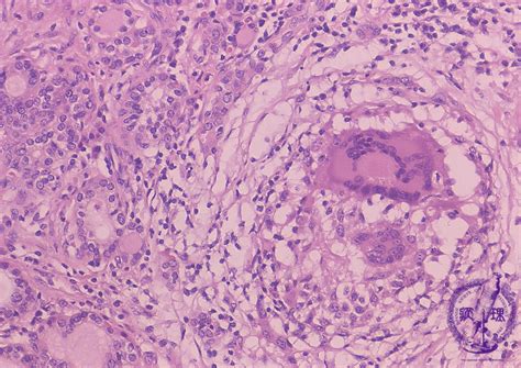 13endocrine 3 Subacute Thyroiditispathology Core Pictures