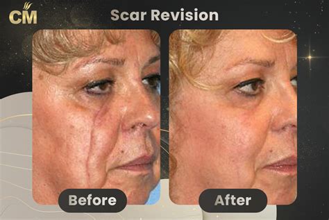 Z Plasty Scar Revision Before After Procedure Guide