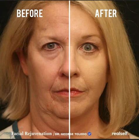 Entry 1 By Veershetty023 For Create Before And After GIF Freelancer