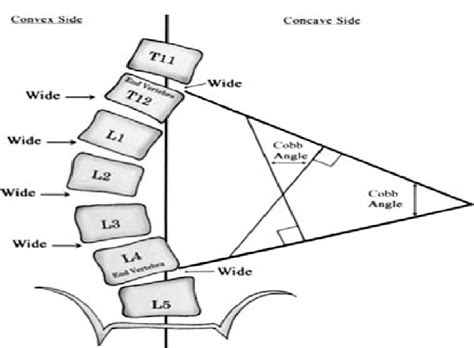 Sagittal View Of Scoliosis Affected Spinal Canal Registration And Atlas Download Scientific
