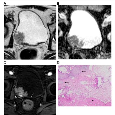 A D A 78 Y O Male With A Polypoid Lesion In Posterolateral Face Of Download Scientific Diagram