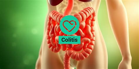 Colitis Understanding Symptoms Causes And Treatments Yesil Health