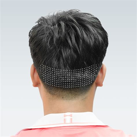 Fue Follicular Unit Extraction Skin Physicians Dermatology