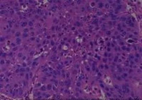 Novus Biologicals Human Lung Tissue Microarray Cancer 1 Slide