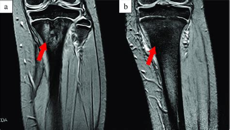 Coronal Ge T2 Mri Of The Left Tibia A In The Left Tibial Proximal Download Scientific
