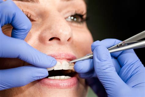 How Long Do Braces Take To Straighten Your Teeth Orthodontics