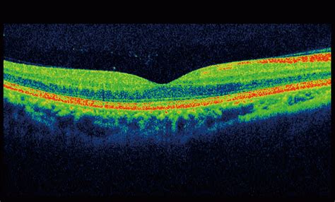 Optical Coherence Tomography Varcoe Eyecare Optometrists
