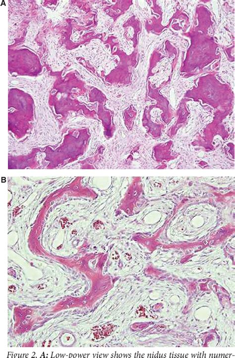 Figure 1 From Osteoid Osteoma Of The Ethmoid Sinus A Rare Diagnosis