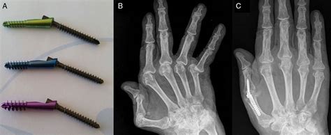 Metacarpophalangeal Joint Of The Thumb Arthrodesis Using Intramedullary Interlocking Screws Xmcp