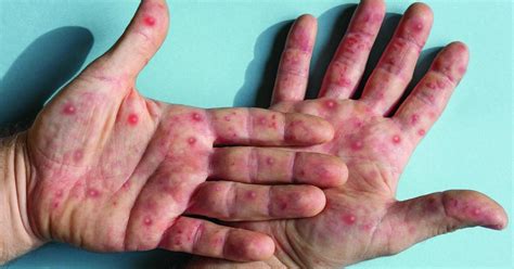 Monkeypox Rate In Malta Is One Of The Highest In Europe