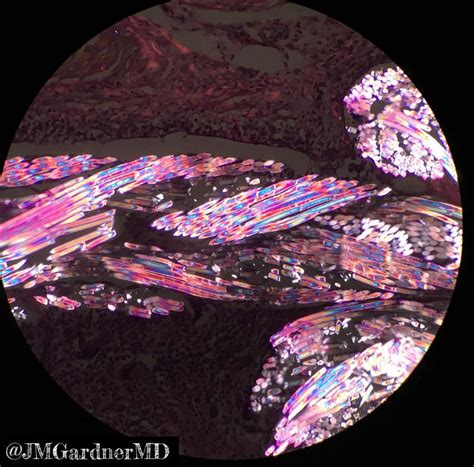 Jerad Gardner Md ‪how I Handle Nonspecific Ulcers On Biopsy To Rule Out Pyoderma Gangrenosum