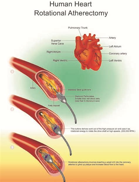 What Is Atherectomy Risks And Treatment Pulse Cardiology